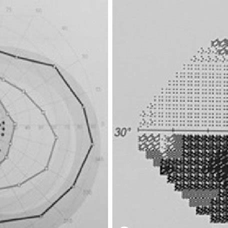 Octopus Visual Field A And Humphrey Visual Field B Of The Download Scientific Diagram