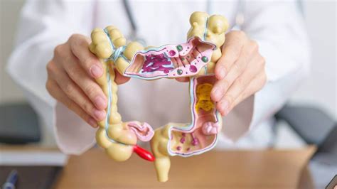 Understanding Colon Polyps Are They Cancer