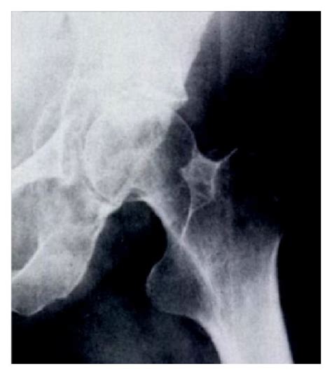 Classification Of Acetabular Defects According To Harrington A