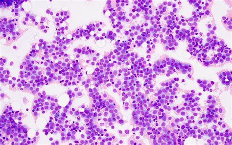 Pathology Outlines Aml With Kat6acrebbp