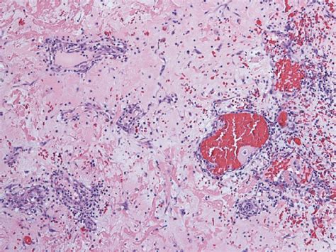Abundant Myxoid Stroma With Clusters Of Myxoma Cells Forming Cords And Download Scientific