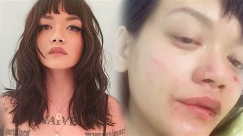 Dylan Model Indonesia Yang Berkarir Di As Dianiaya Wajah Penuh Luka