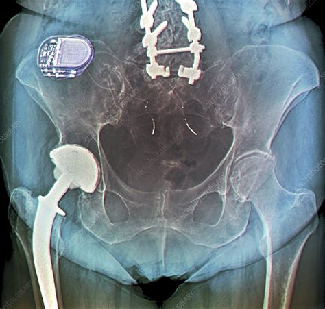 X Ray Of Implant For Incontinence Stock Image C Science Photo Library