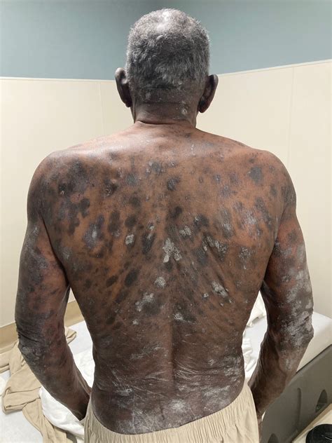 Mycosis Fungoides Published In Journal Of Brown Hospital Medicine