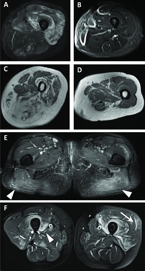 Comparison Of The Mri Findings Of Anti Srp Myopathy And Anti Ars