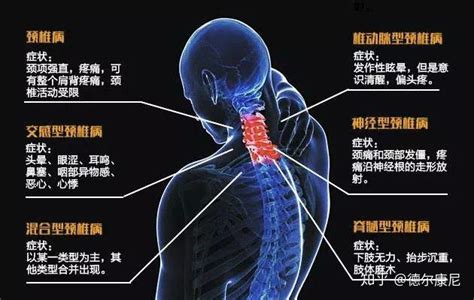 颈椎病引起的头晕怎么治疗最有效 知乎