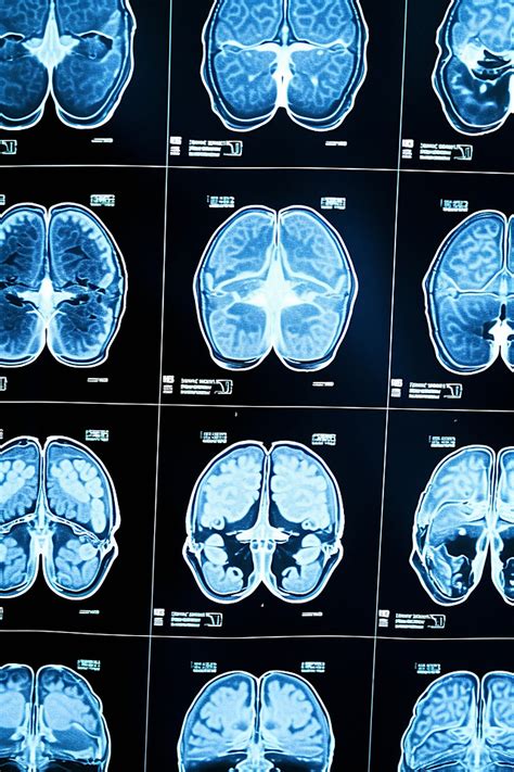 100 뇌의 Mri 사진 무료 다운로드 사진 그림 및 배경 이미지 Pngtree