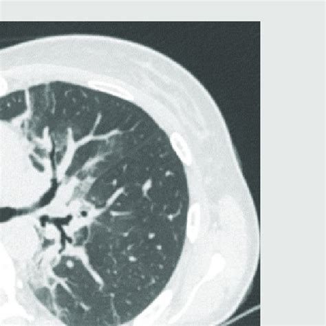Ct Scan Transverse Section March 2017 Showing Bronchiectasis With Download Scientific