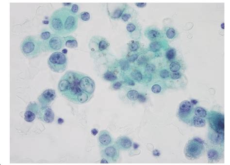 Cytology Of The Right Pleural Effusion Showed Malignant Cells Which