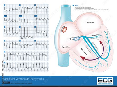 Poster A Fascicular Ventricular Tachycardia Is An Idiopathic Ventricular Tachycardia That