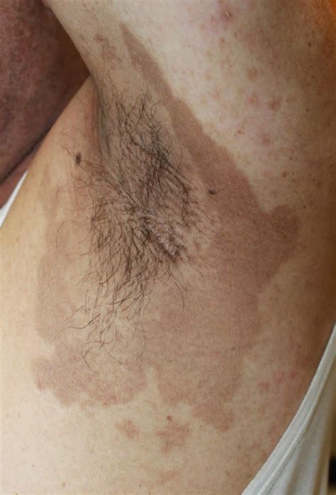 Erythrasma Causes Symptoms Diagnosis Home Or Over The Counter Treatment