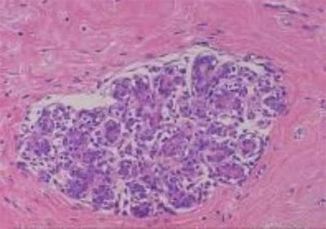 Novus Biologicals™ Human Breast Tissue Microarray Cancer Human Breast