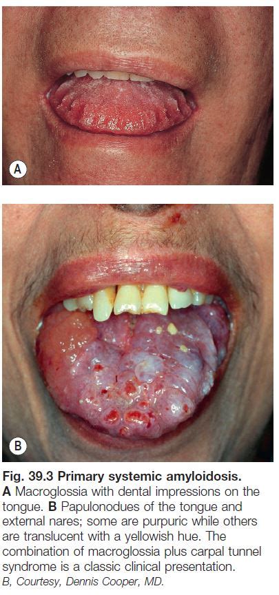 Amiloidosis Por Macroglosia