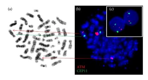 The Patients Bone Marrow Cell Culture A Metaphase Staining By