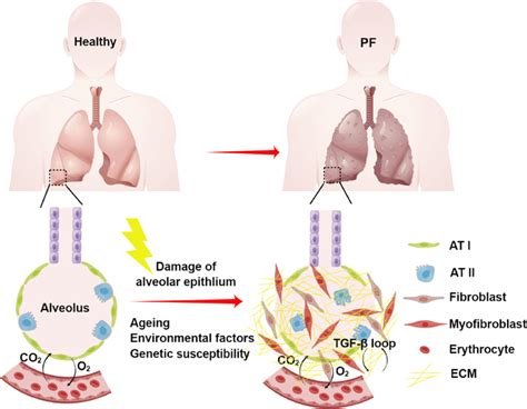 The Pathogenetic Model Of PF Aging Associated Changes Environmental Download Scientific
