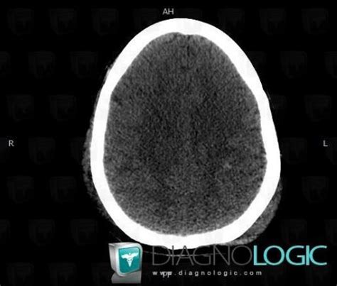 Radiology Case Diffuse Axonal Injury CT Diagnologic