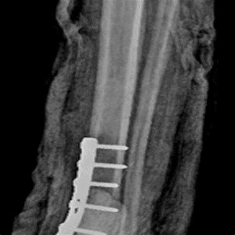 A Bone Lytic Lesion With Undefined Margins In The Middle Part Of Tibia