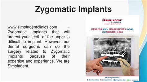 Ppt Zygomatic Implants Powerpoint Presentation Free Download Id