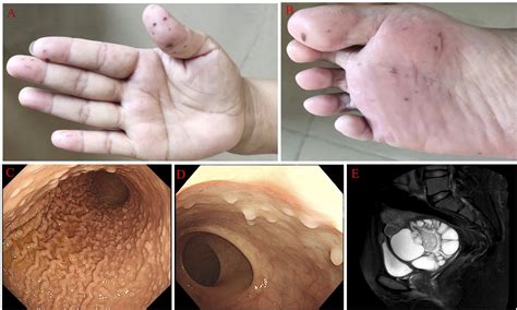 Frontiers Gastric Type Endocervical Adenocarcinoma Superficial Myofibroblastoma Sex Cord