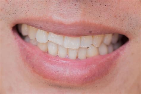 Why Do My Teeth Chip So Easily Toothsome Implants Chatswood