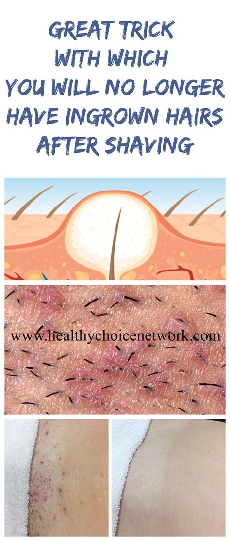 How To Get Rid Of Ingrown Hair Bumps On Arms At Brian Randell Blog
