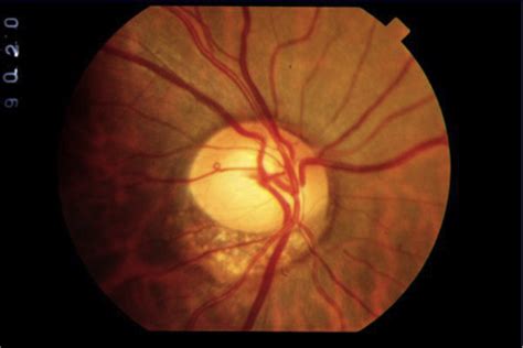Tilted Optic Disc