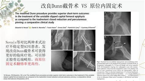 早读 关于股骨头骨骺滑脱的诊治策略这篇课件我打满分 上海开为医药科技有限公司 创伤肢体矫形技术解决方案的专业服务商