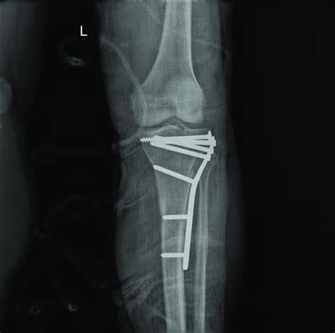 Postoperative Anteroposterior Radiograph Showing Fixation Of The Download Scientific Diagram