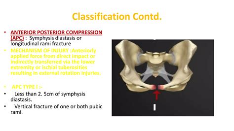 Classification Of Pelvic Fracture Pptx