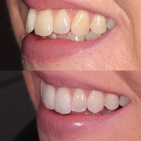 Invisalign And Composite Bonding Case 3 Headrow Dental