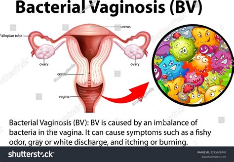 Bacterial Vaginosis Bv Infographic Explanation Illustration Stock Vector Royalty Free