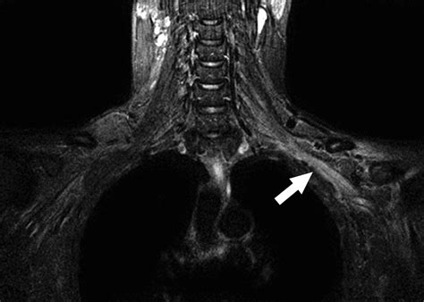 Brachial Plexus Anatomy Mri