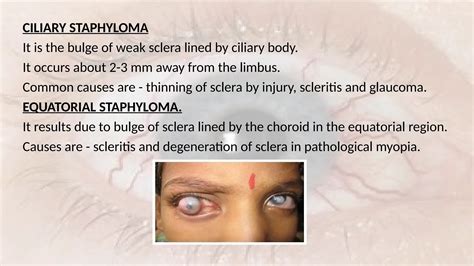 Diseases Of Sclera Diseases Of Sclerapptx Pptx