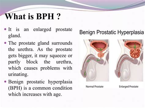 Benign Prostate Hypertrophy Pptx