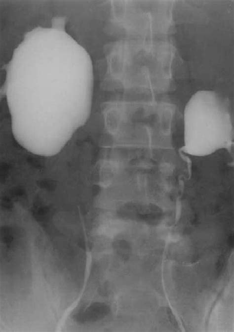 Bilateral Retrograde Pyelography Indicates Bilateral Ureteropelvic Download Scientific Diagram