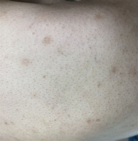 여드름 흉터와 착색 문제 해결 어떻게 하면되나요 ㅣ 궁금할 땐 아하