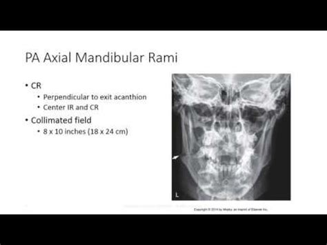 Inferior Border Of Mandible X Ray