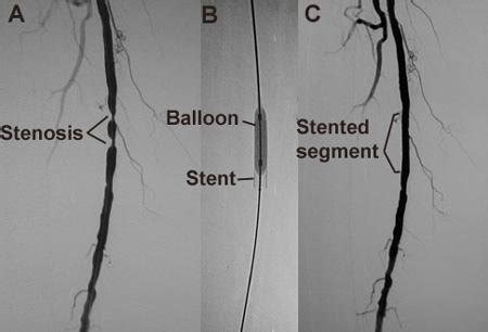 6 A Preoperative Angiogram Showing Stenosis Of The Femoral Artery B