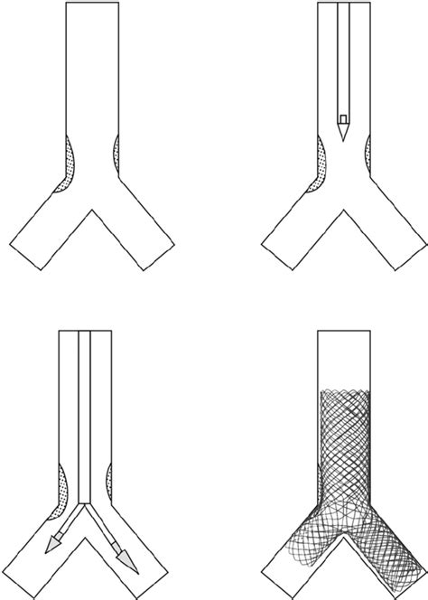 Schematic Diagram Showing The Placement Of The Self Expanding Metallic Download Scientific