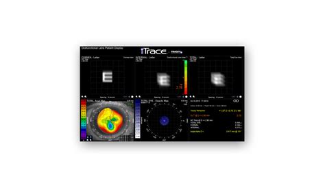 Tracey Technologies™ Itrace Wavefront Aberrometer And Corneal Topography