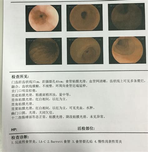 胃食管反流病的外科治疗