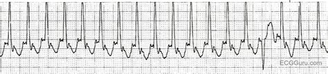 Atrial Flutter With Conduction ECG Guru Instructor Resources