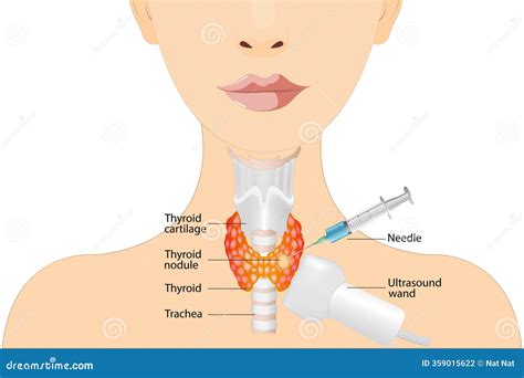 Fine Needle Aspiration Biopsy Of The Thyroid Gland In A Patient Using