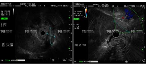 U M U Trong Gan Ng Y Trang Th Nh Kh I U Nguy Hi M D D Y B O D N Tr