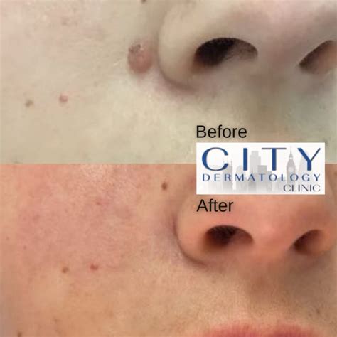 Shave Excision Mole Removal How It Works And What To Expect
