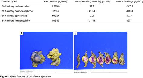 24 H Urinary Metanephrine And Catecholamine Measurements Download
