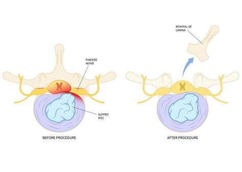 Lumbar Laminectomy Decompression Clear Lake Houston Sugar Land Tx