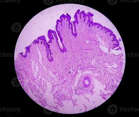Histological Biopsy Of Scrotal Wall Under Microscopy Showing Calcinosis Cutis Scrotal