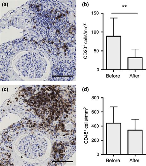 A Representative Cd20 Staining B Allograft Cd20 Positive Cells Download Scientific Diagram