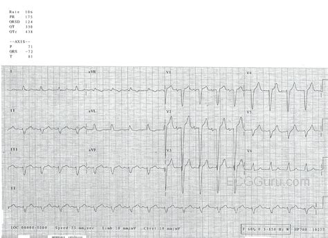 Left Bundle Branch Block ECG Guru Instructor Resources